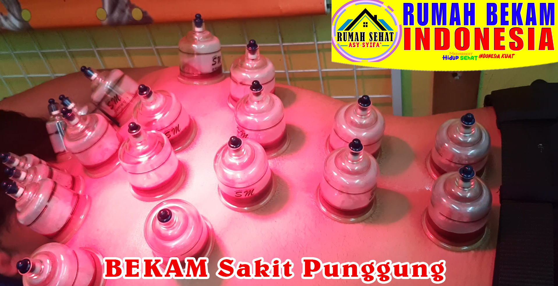 BEKAM Sakit Punggung – Rumah Bekam Indonesia